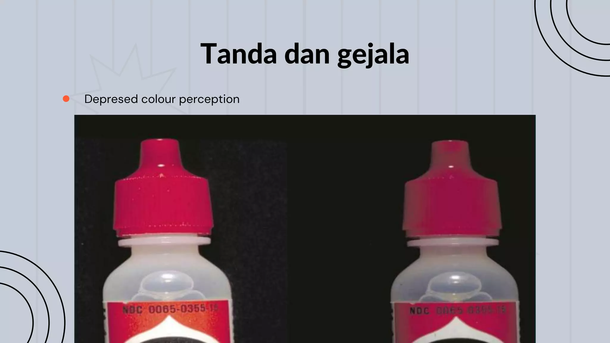 Papilitis.pptx