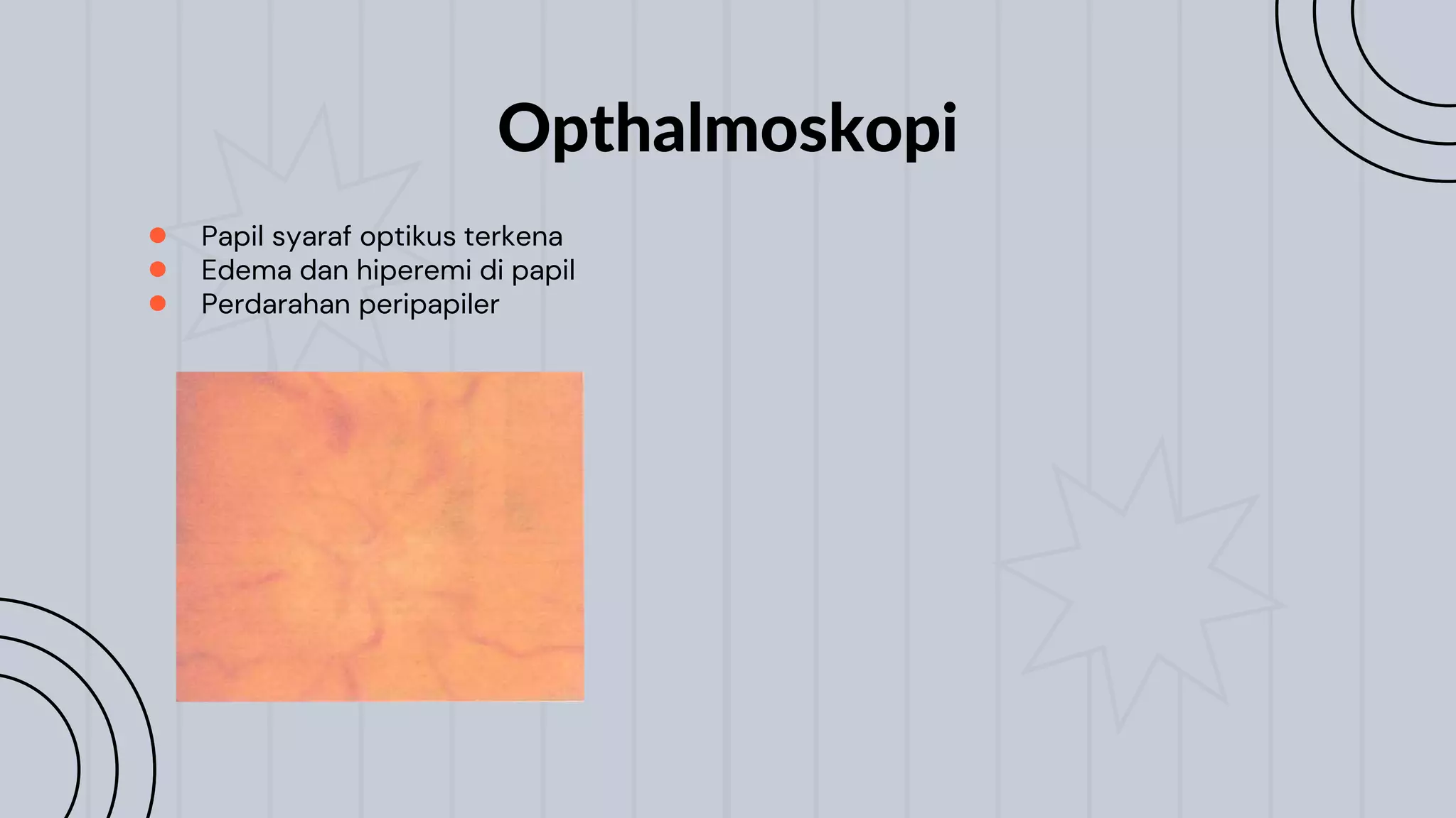 Papilitis.pptx