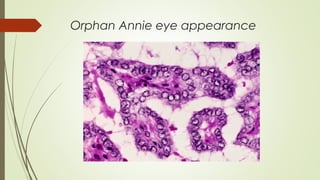 Papillary Thyroid Cancer Orphan Annie Eyes
