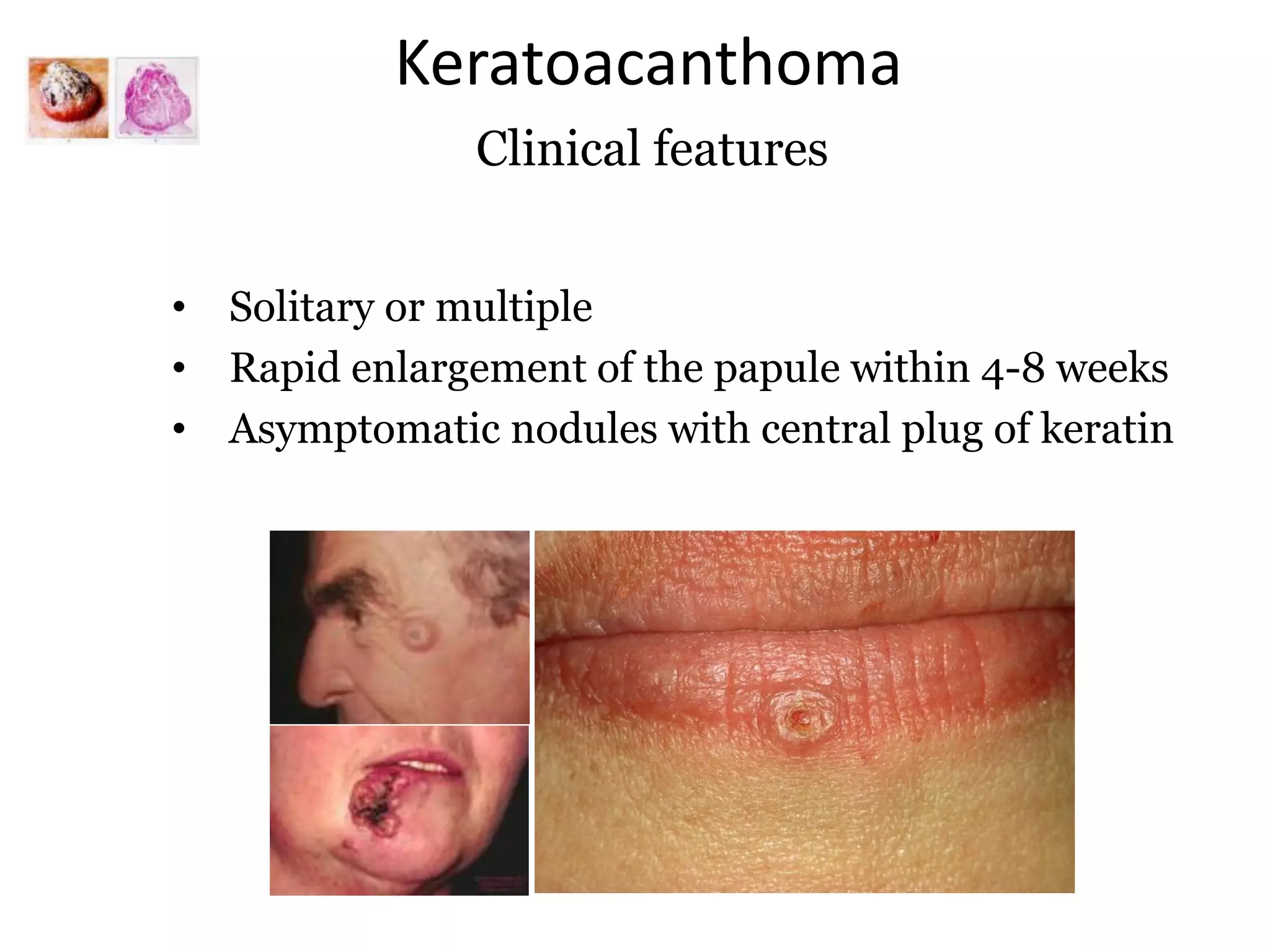 Papillary lesions | PDF