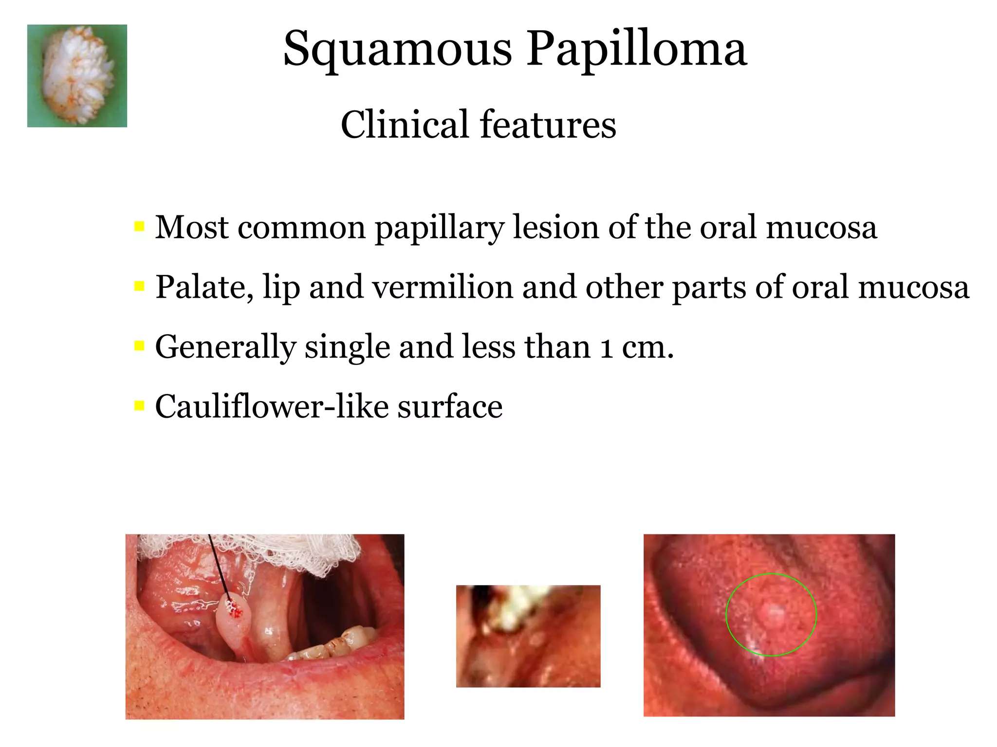 Papillary lesions | PDF
