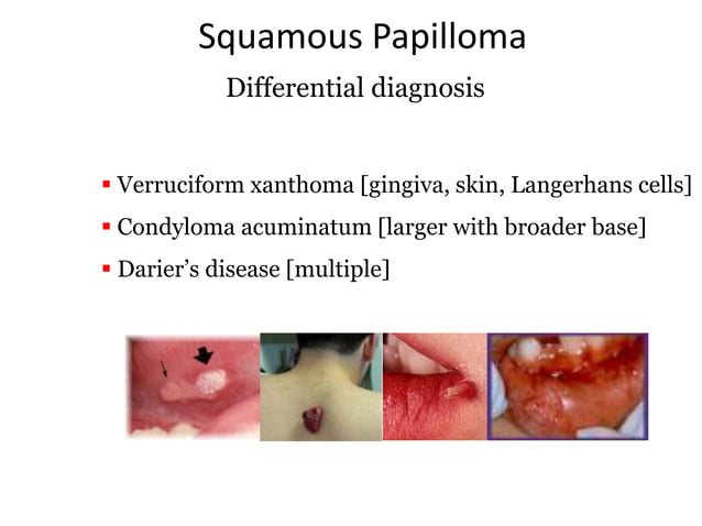 Papillary lesions | PDF