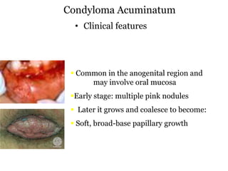 Papillary lesions | PPT