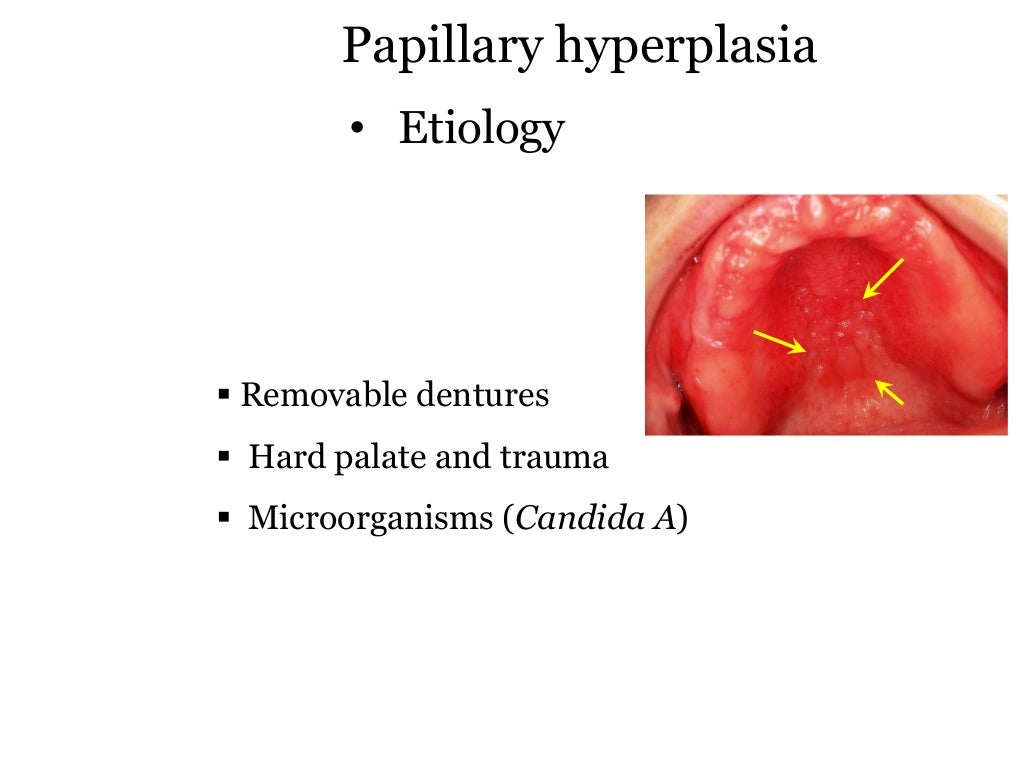 Papillary lesions