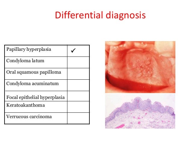 Papillary lesions