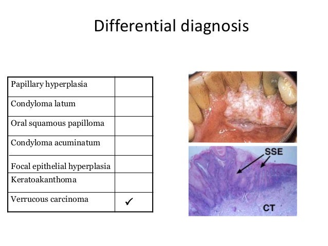 Condyloma Lata Vs Acuminata | Genital warts – YAZEGZ