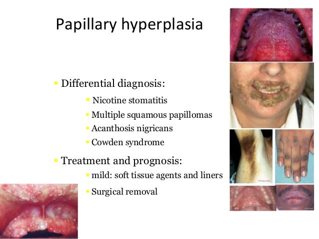 Papillary lesions