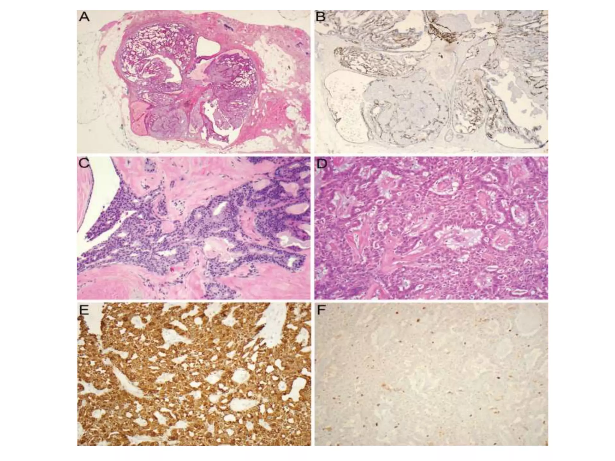 papillary lesions of the breast.pptx