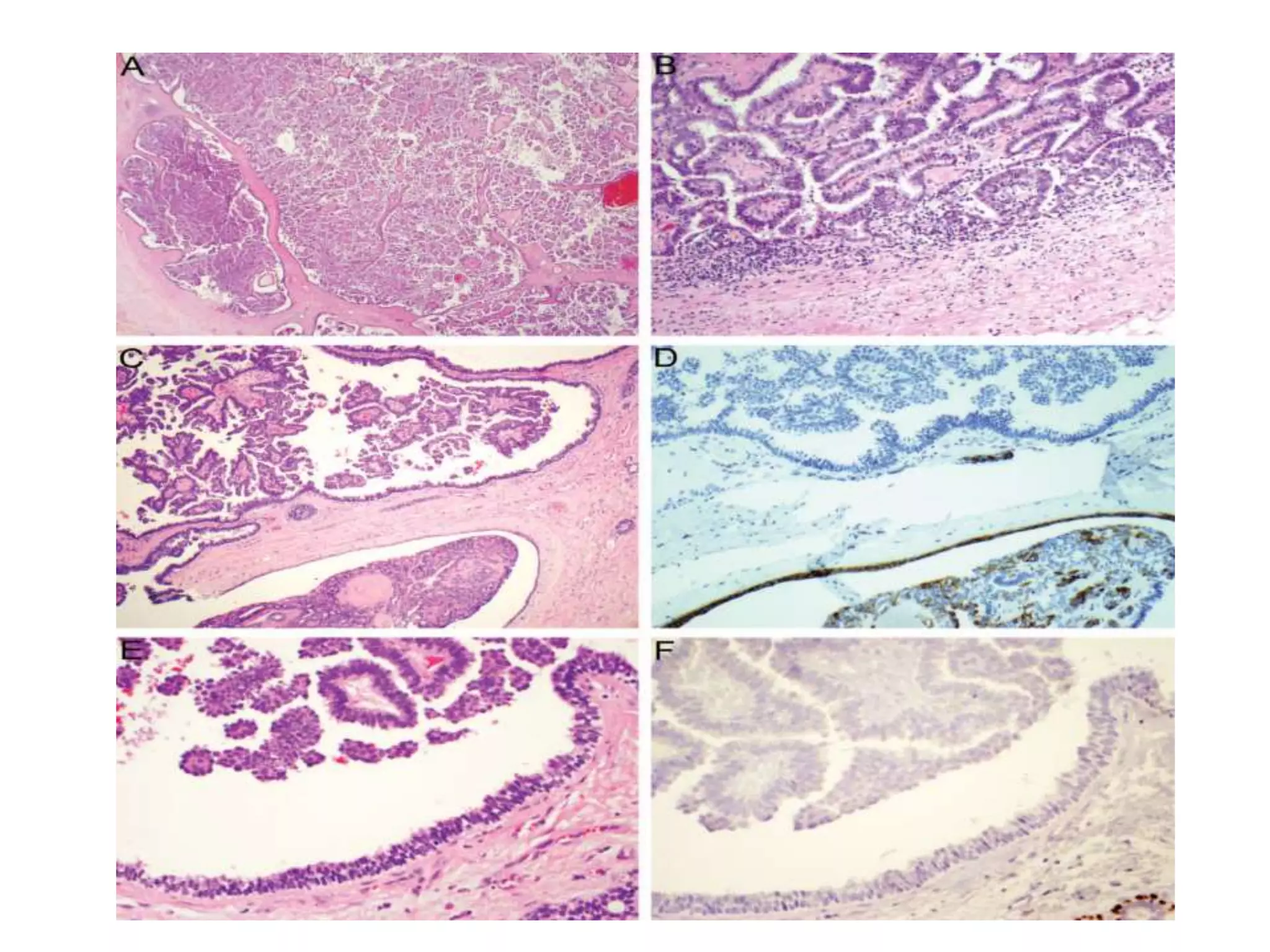 papillary lesions of the breast.pptx