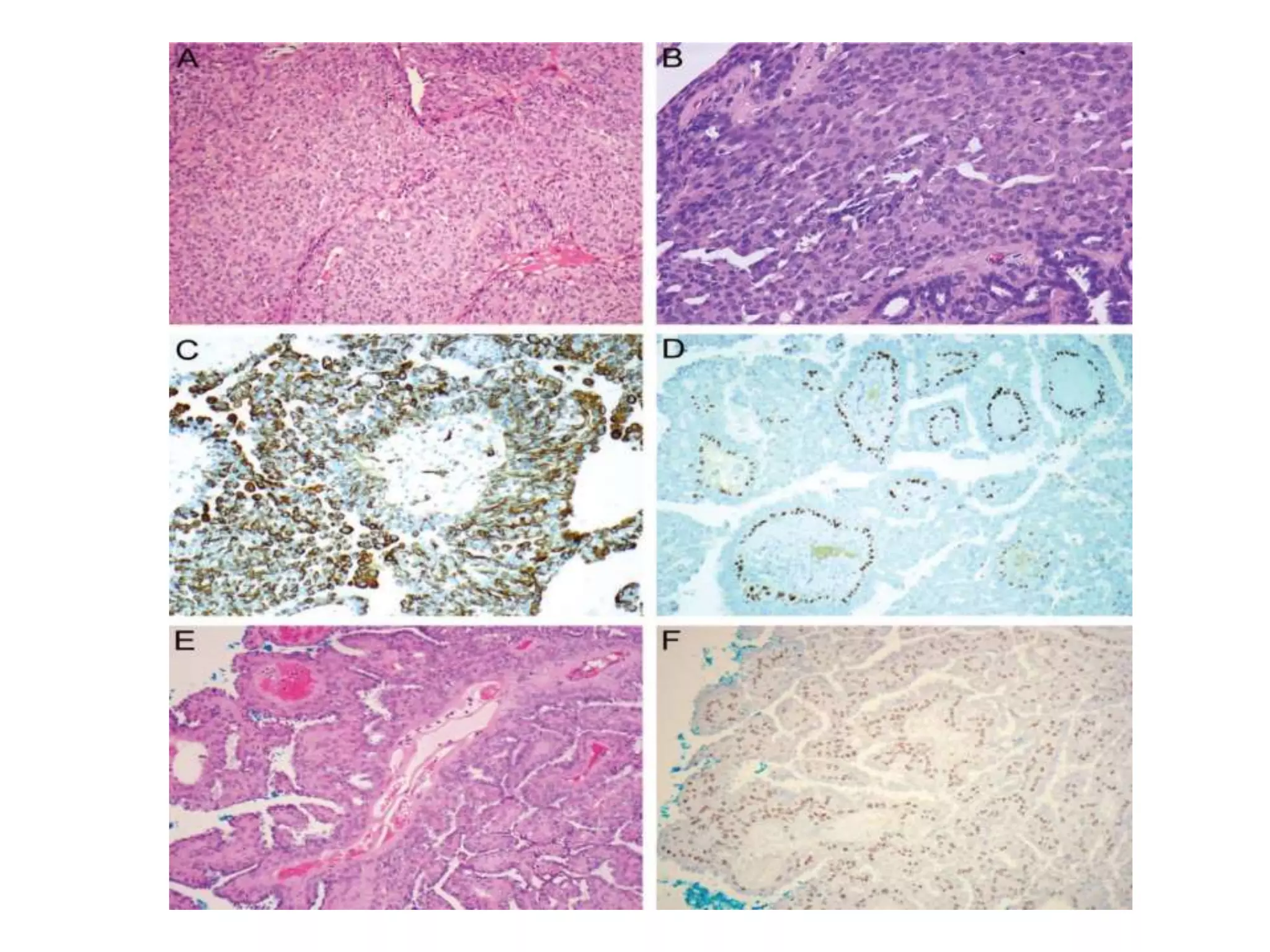 papillary lesions of the breast.pptx