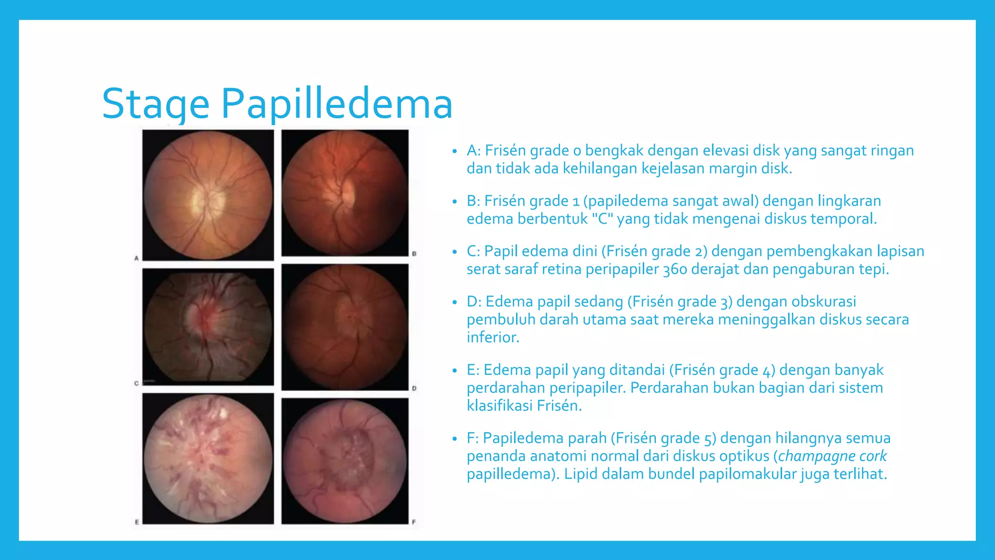 Papilledema.pptx