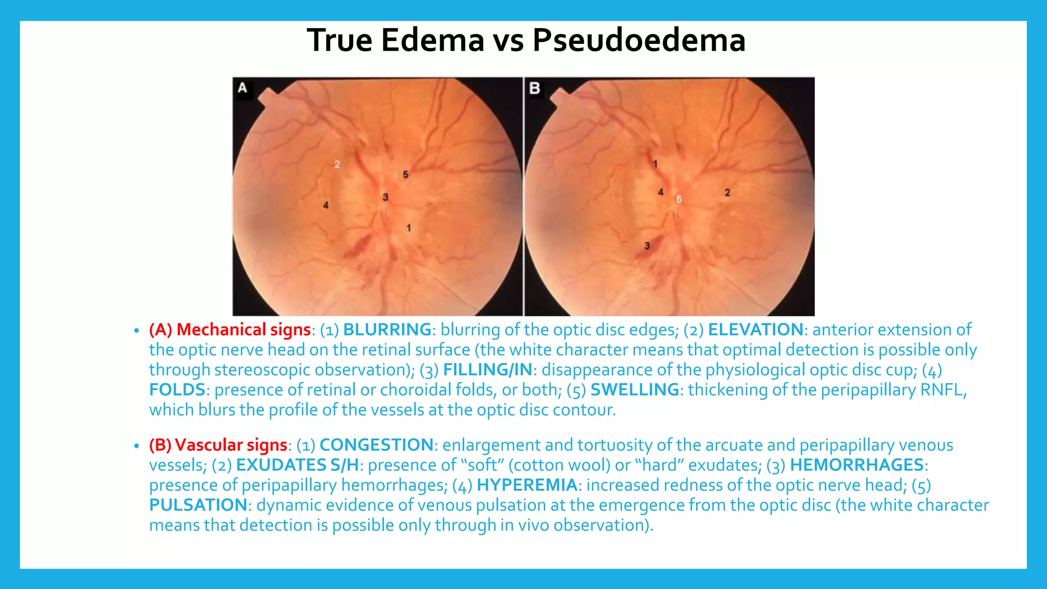 Papilledema.pptx