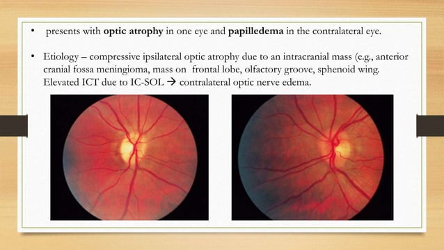 Papilledema.pptx