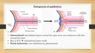 Papilledema.pptx