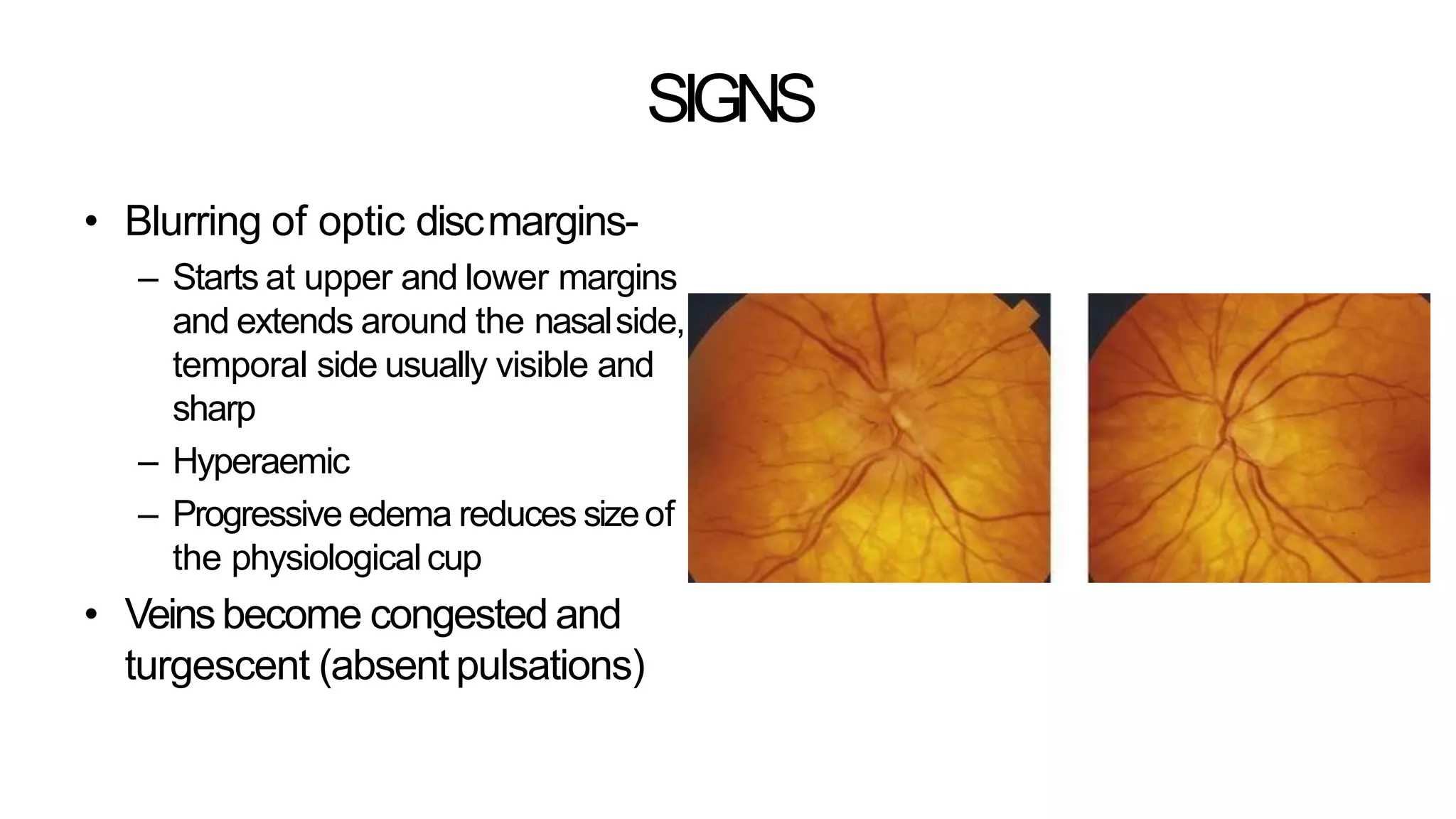 Papilledema | PPTX | Eye and Vision Conditions | Diseases and Conditions