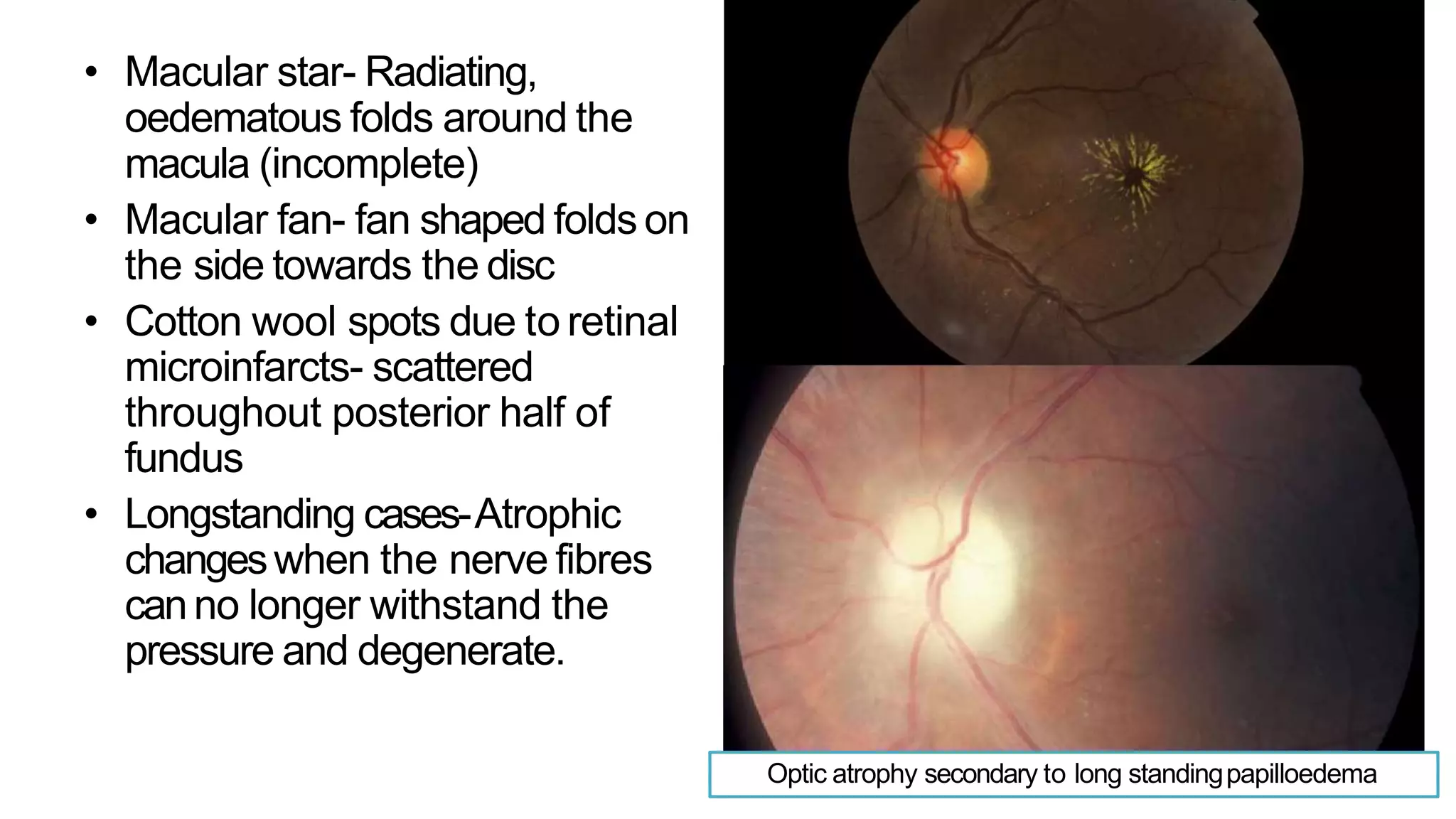 Papilledema | PPTX