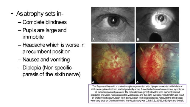 Papilledema | PPTX | Eye and Vision Conditions | Diseases and Conditions