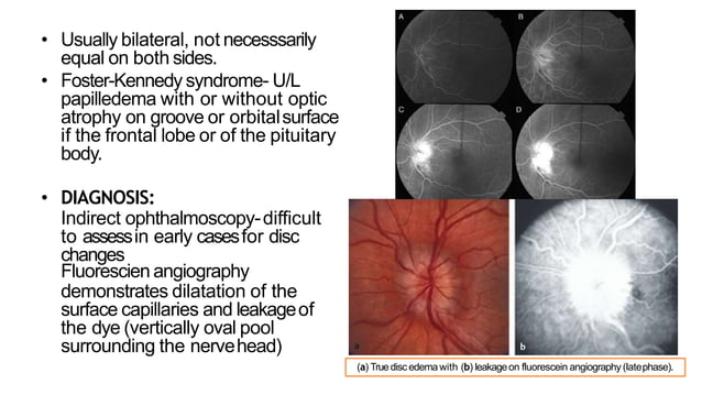 Papilledema | PPTX | Eye and Vision Conditions | Diseases and Conditions