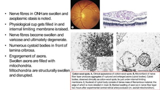 Papilledema | PPTX | Eye and Vision Conditions | Diseases and Conditions
