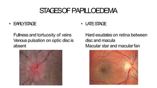 Papilledema | PPTX | Eye and Vision Conditions | Diseases and Conditions