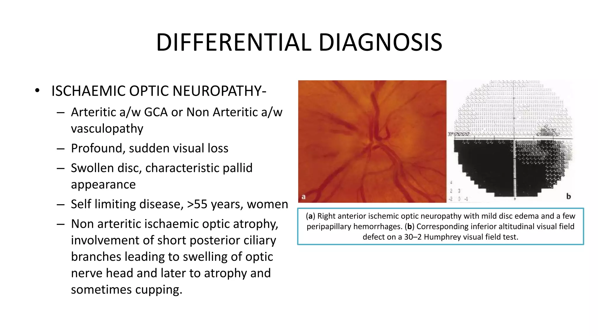 PAPILLEDEMA | PPTX