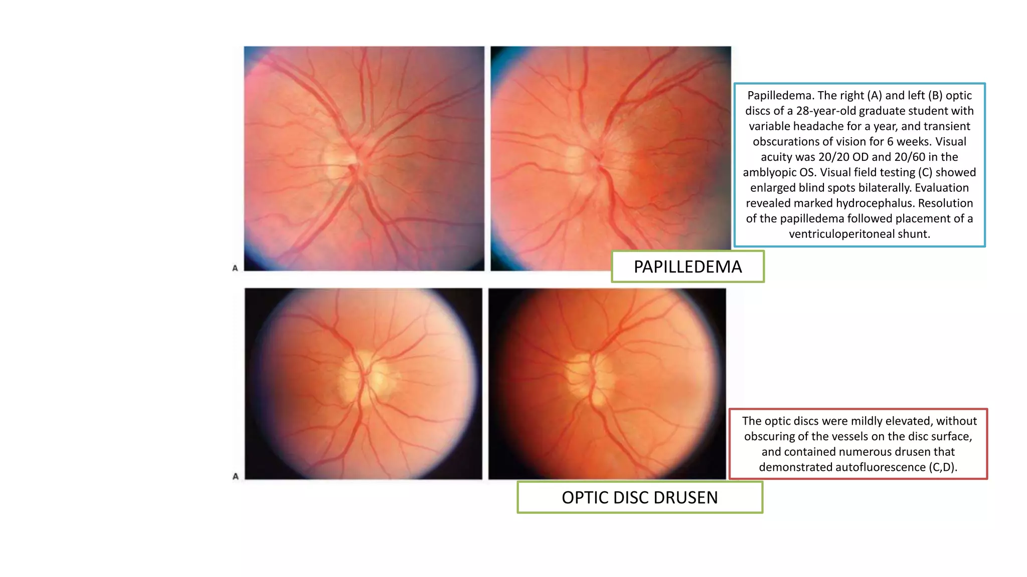 PAPILLEDEMA | PPTX
