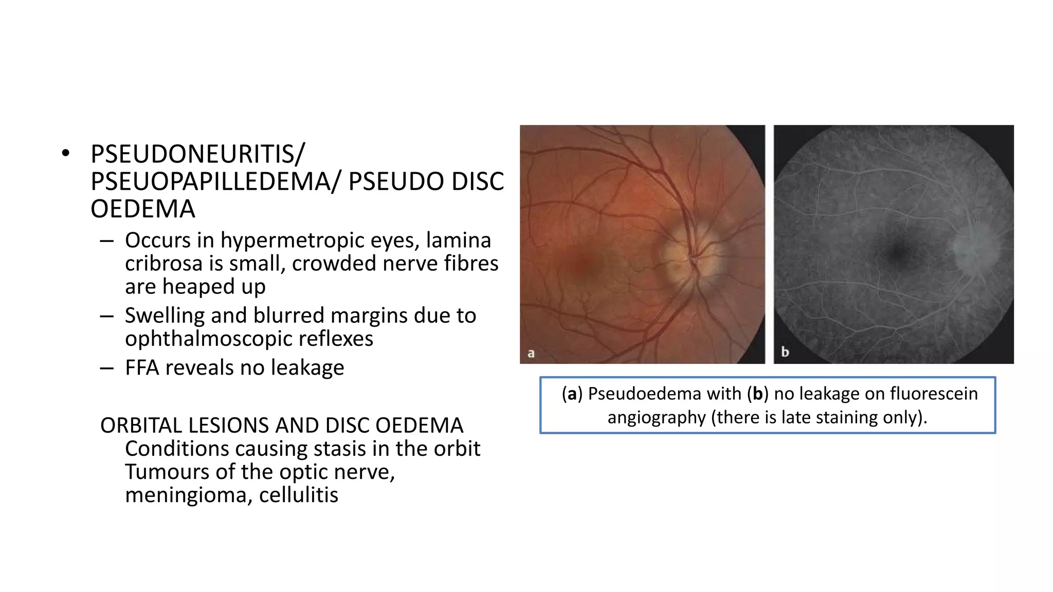 PAPILLEDEMA | PPTX