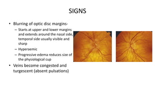 PAPILLEDEMA | PPTX