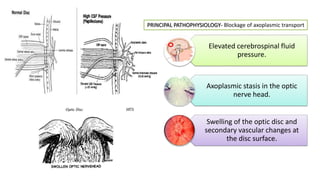 PAPILLEDEMA | PPTX