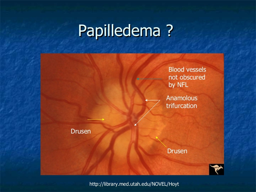 Papilledema Or No Papilledema
