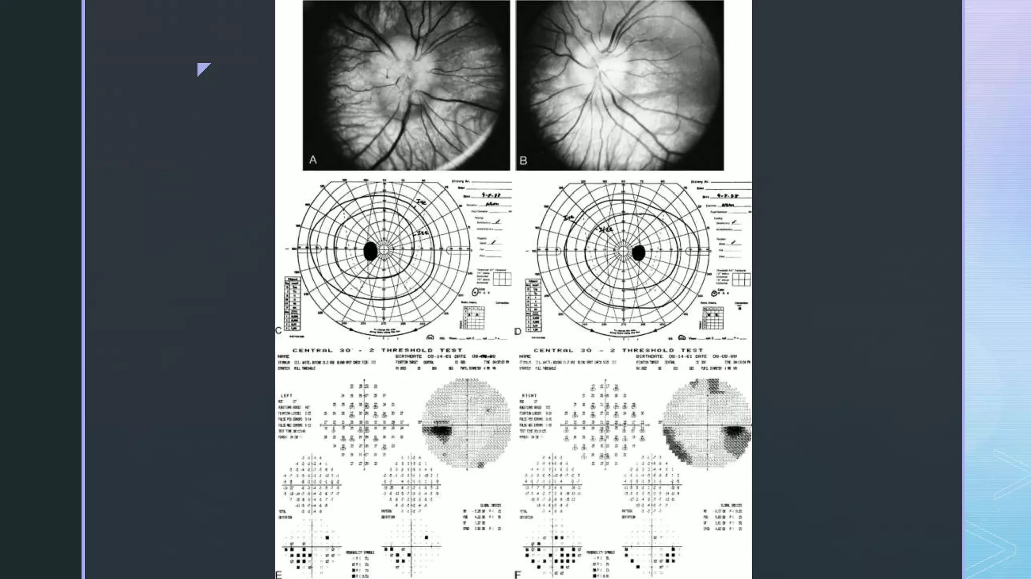 Papilledema - Optic Nerve Head Swelling | PPTX