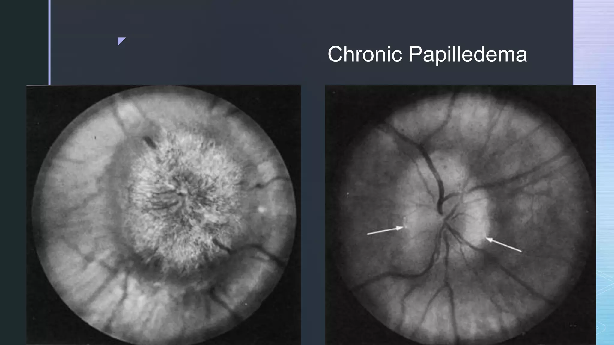 Papilledema - Optic Nerve Head Swelling | PPTX
