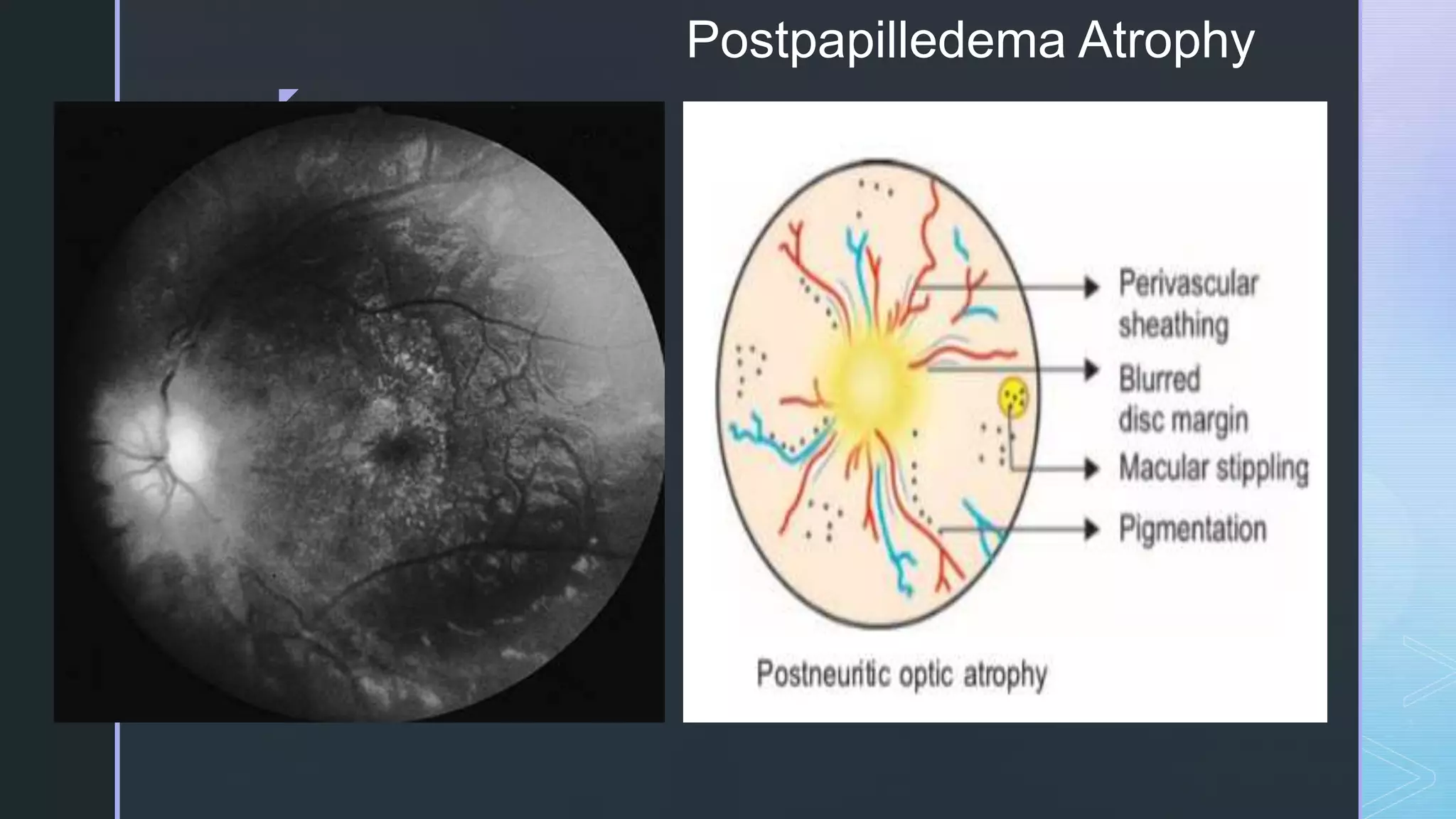 Papilledema - Optic Nerve Head Swelling | PPTX