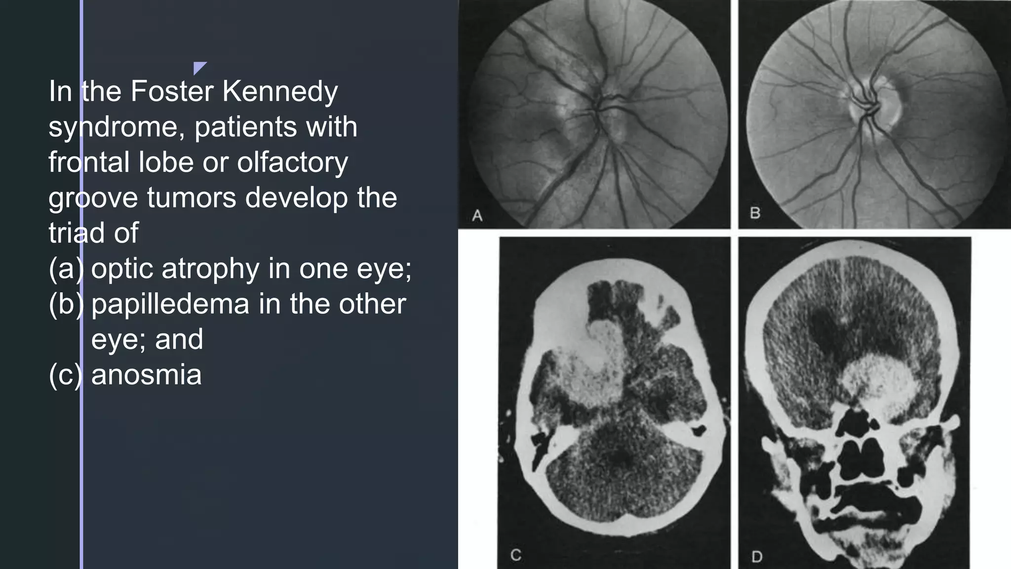 Papilledema - Optic Nerve Head Swelling | PPTX