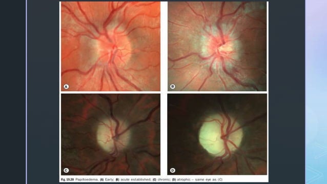 Papilledema - Optic Nerve Head Swelling | PPT