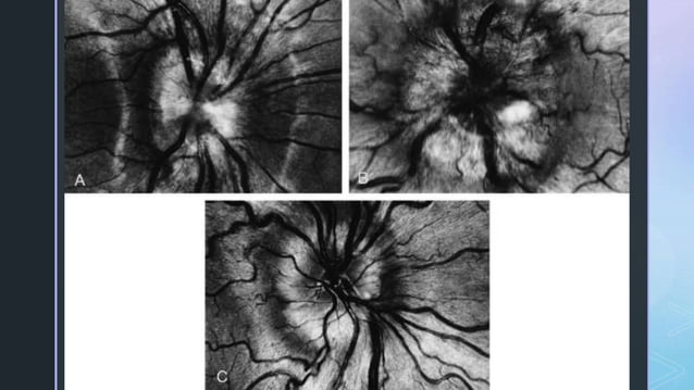 Papilledema - Optic Nerve Head Swelling | PPT
