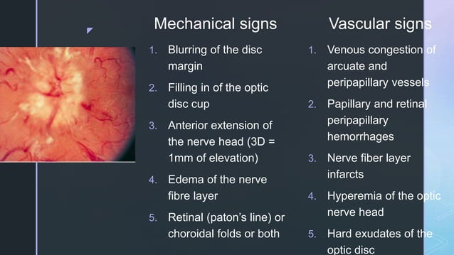 Papilledema - Optic Nerve Head Swelling | PPT