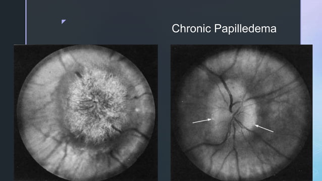 Papilledema - Optic Nerve Head Swelling | PPT