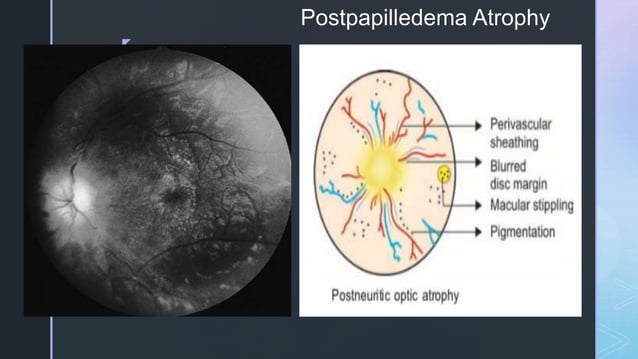 Papilledema - Optic Nerve Head Swelling | PPT