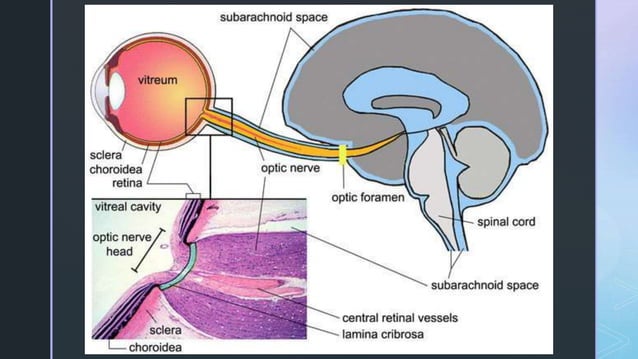Papilledema - Optic Nerve Head Swelling | PPT