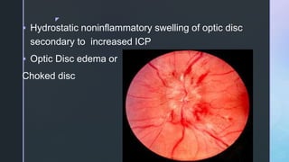 Optic Disc Edema