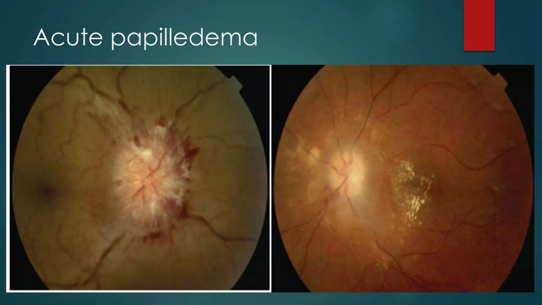 Papilledema vs papillitis with notes timothy zagada | PPTX