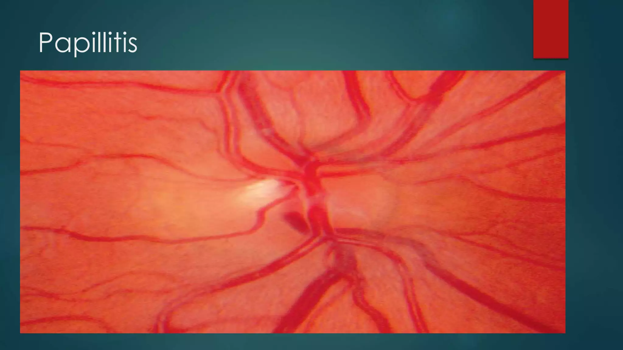 Papilledema vs papillitis with notes timothy zagada | PPTX