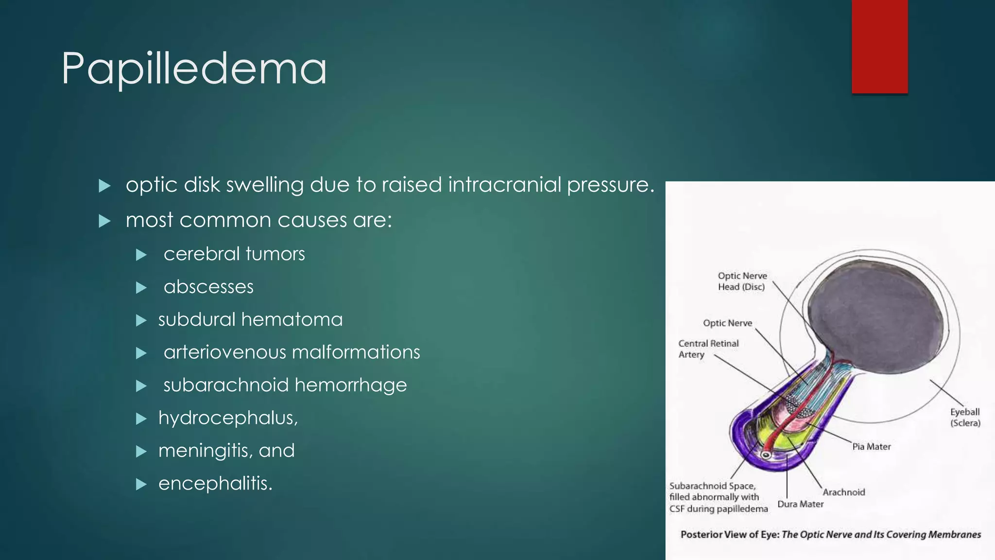 Papilledema vs papillitis with notes timothy zagada | PPTX