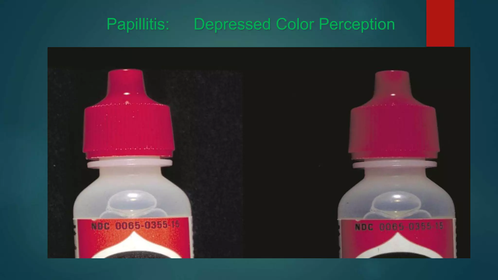 Papilledema vs papillitis with notes timothy zagada | PPTX