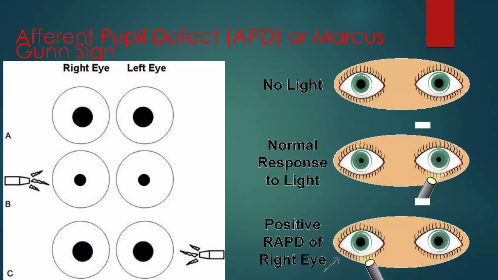 Papilledema vs papillitis with notes timothy zagada | PPTX