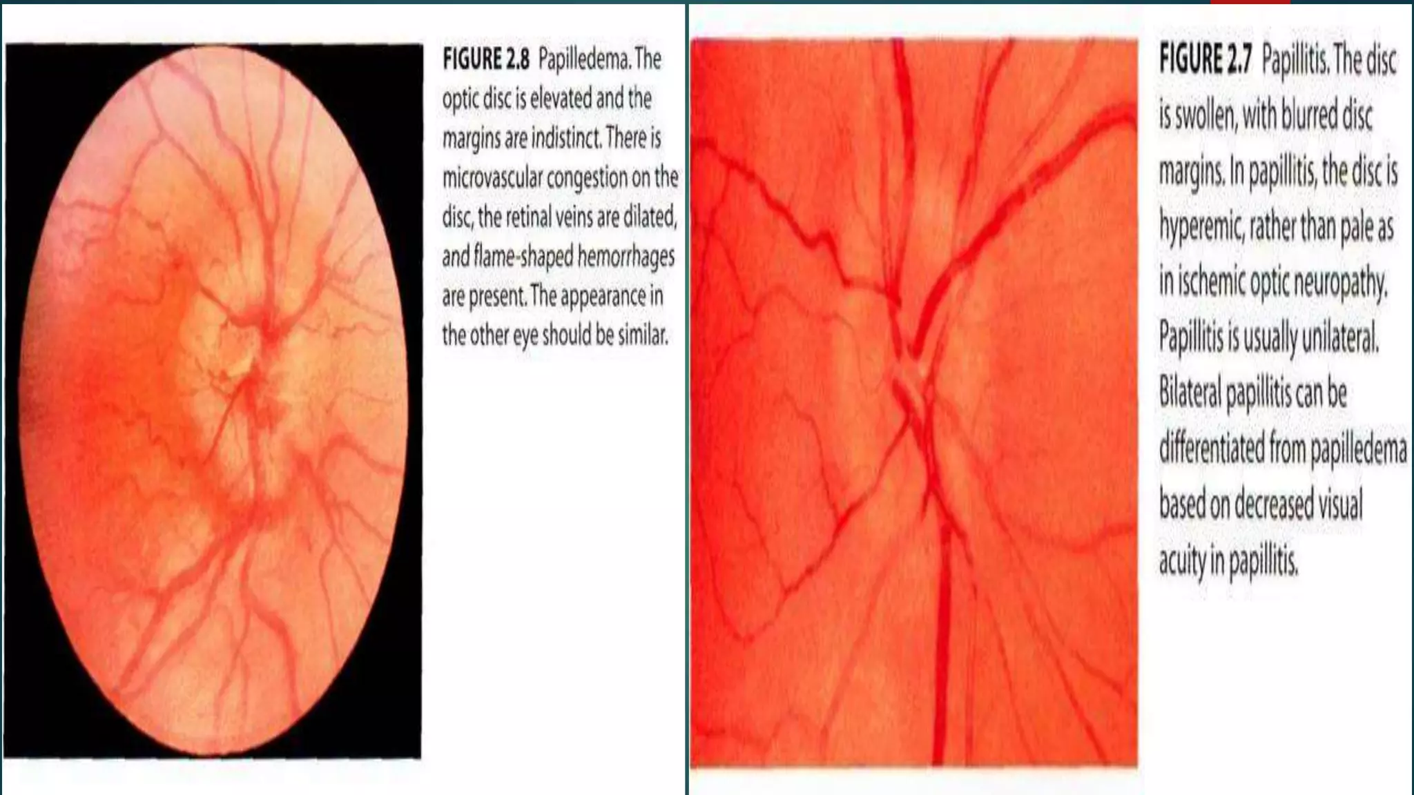 Papilledema vs papillitis with notes timothy zagada | PPTX
