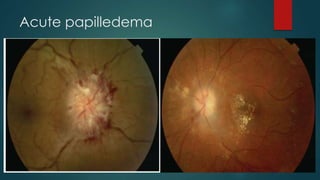 Papilledema vs papillitis with notes timothy zagada | PPTX