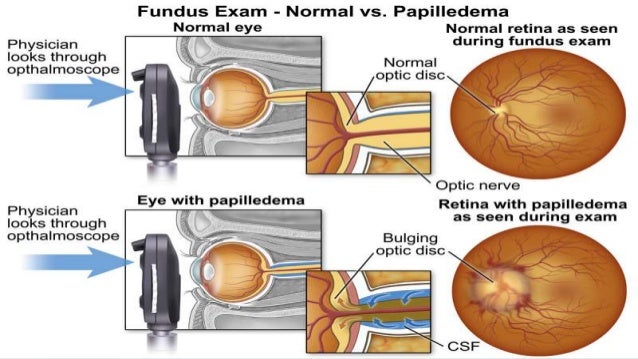 Papilledema vs papillitis with notes timothy zagada