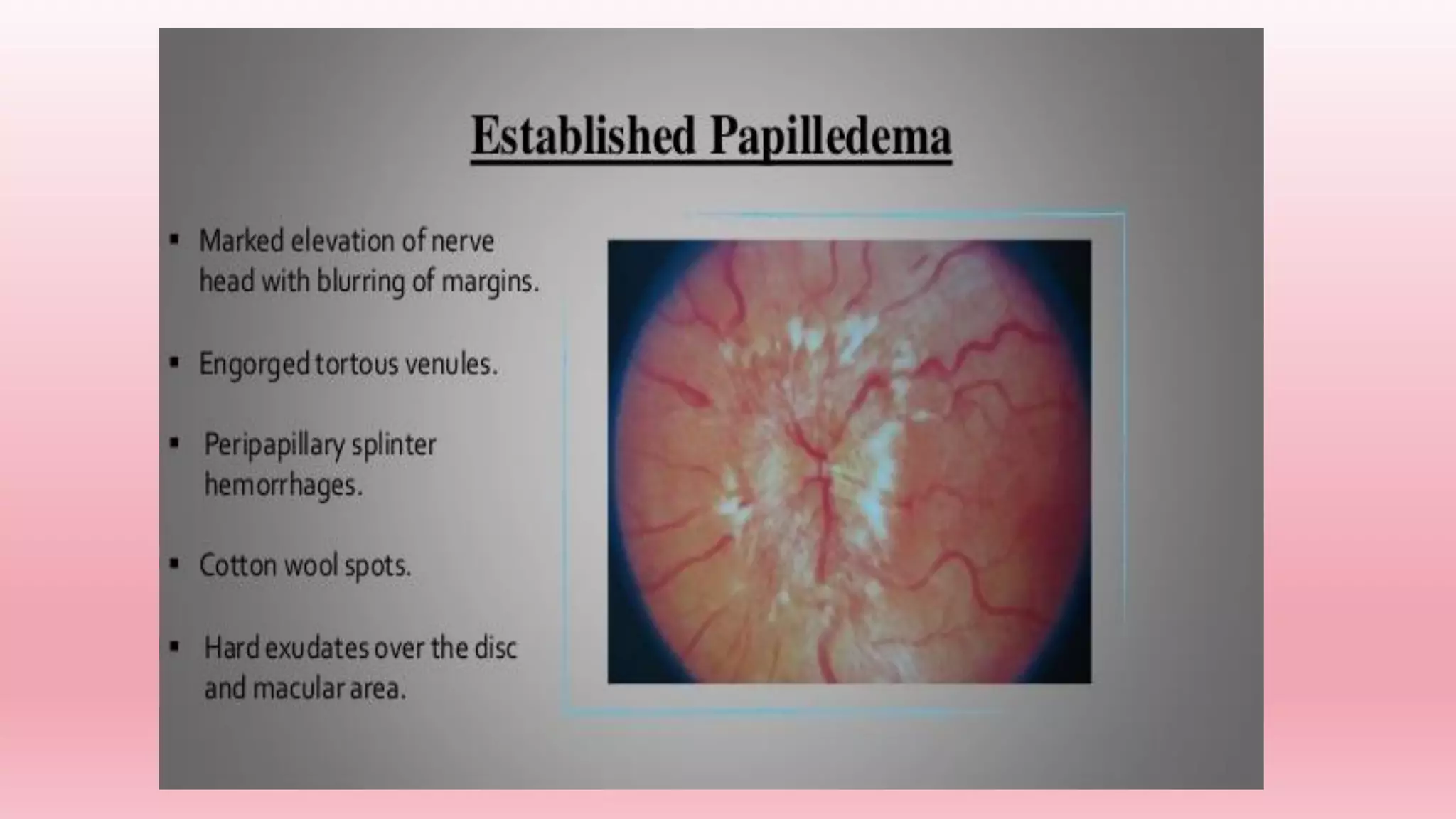 Papilloedema | PDF